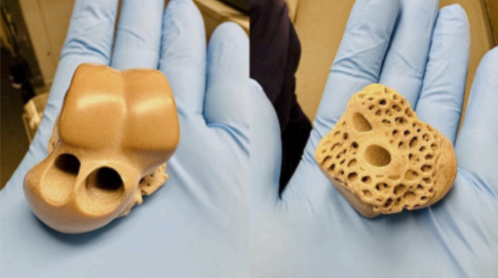 In medical first, Dominican Hospital surgeon combines artificial bone ...